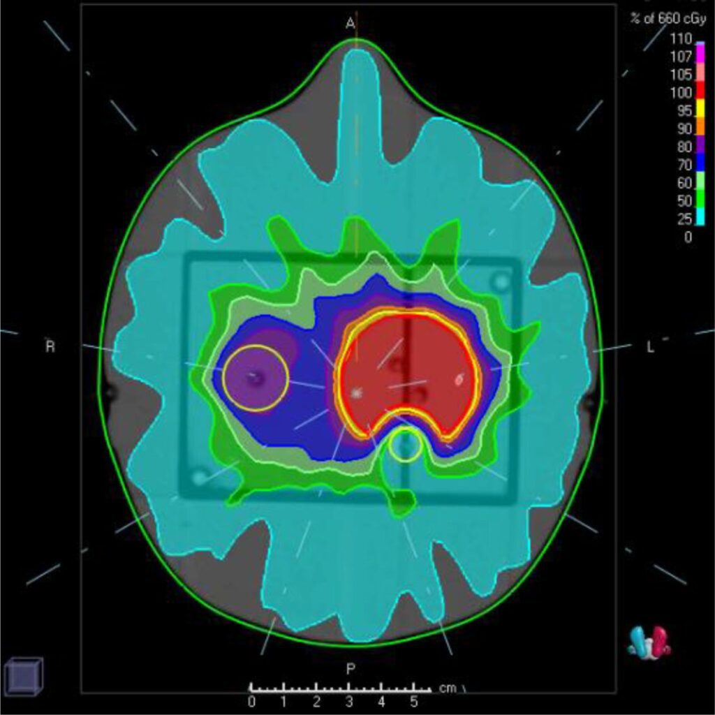 Calculating Monitor Unit (MU) in Radiation Therapy with Monte Carlo ...