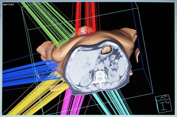 The Importance of Independent Secondary Verification in Radiation Therapy