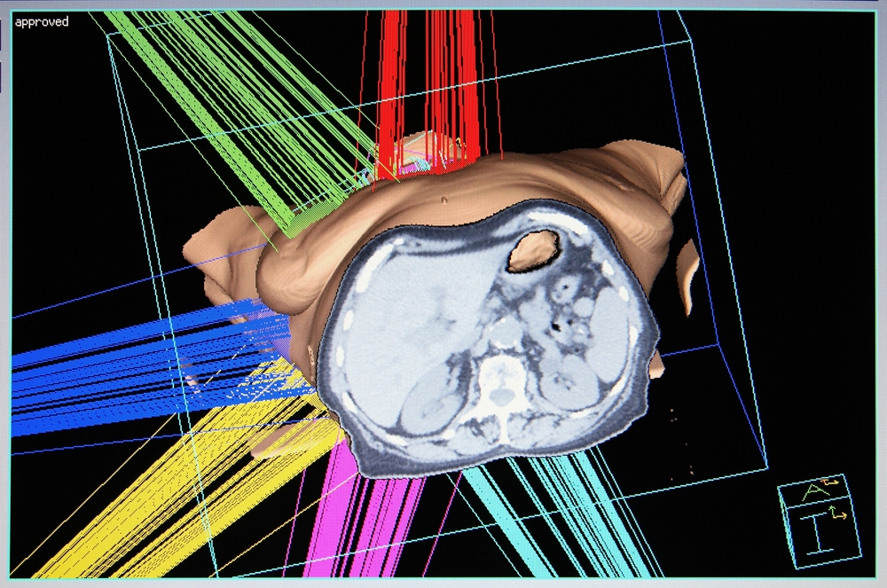 Revolutionizing Cancer Care: The Impact of ChatGPT in Radiotherapy